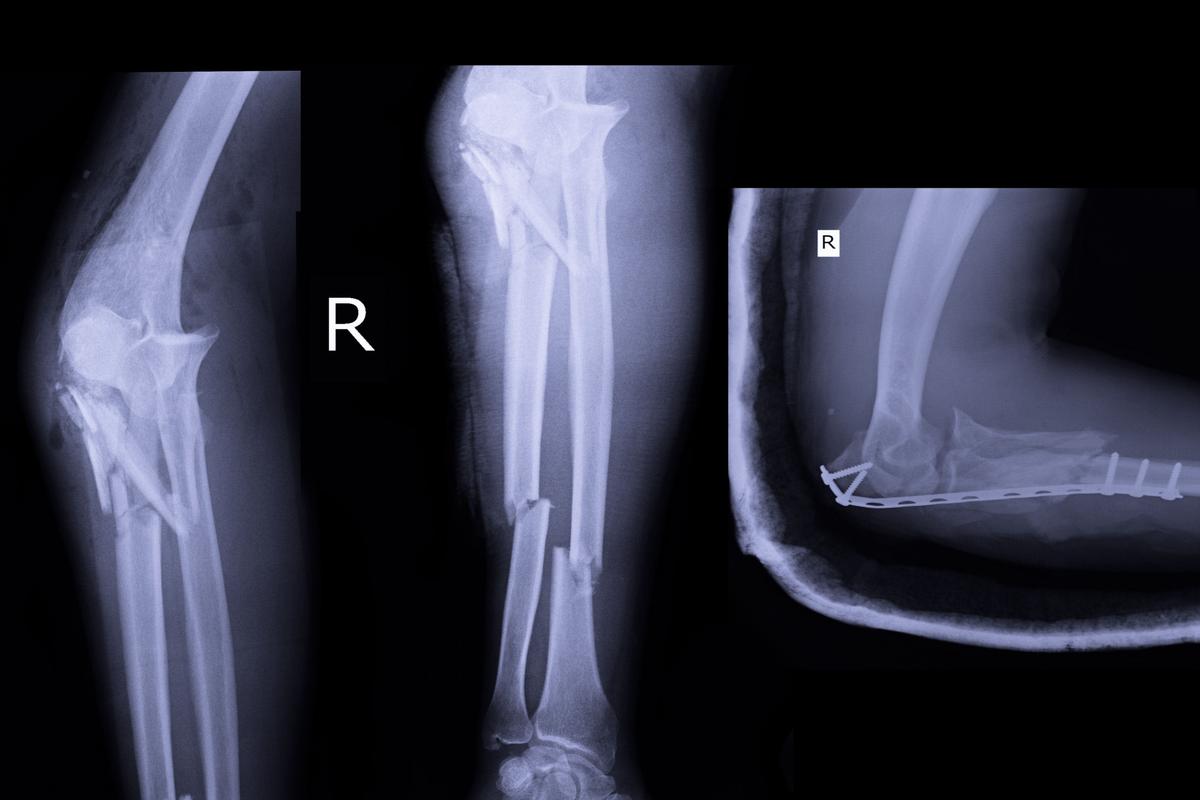 Fractures : types, causes et traitements | Thuasne®